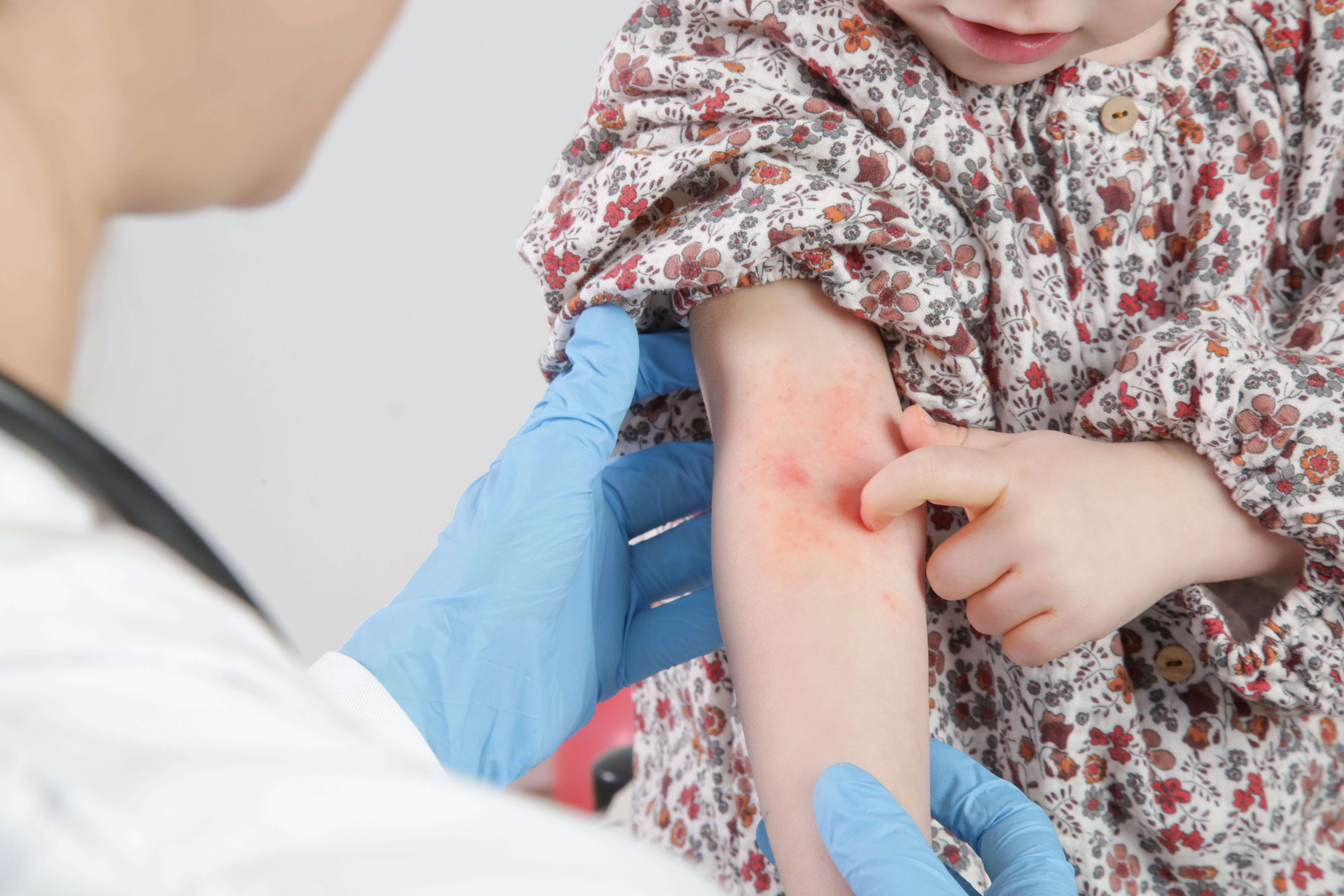 Allergy & Immunology | UNC Health