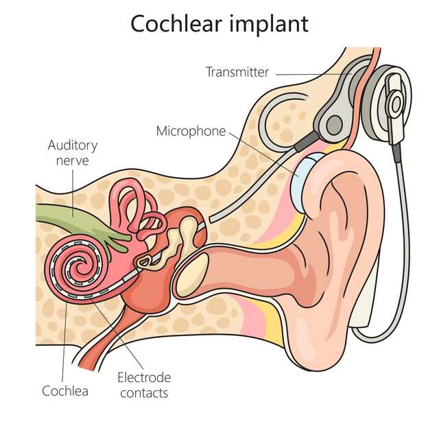 Cochlear Implants | UNC Health