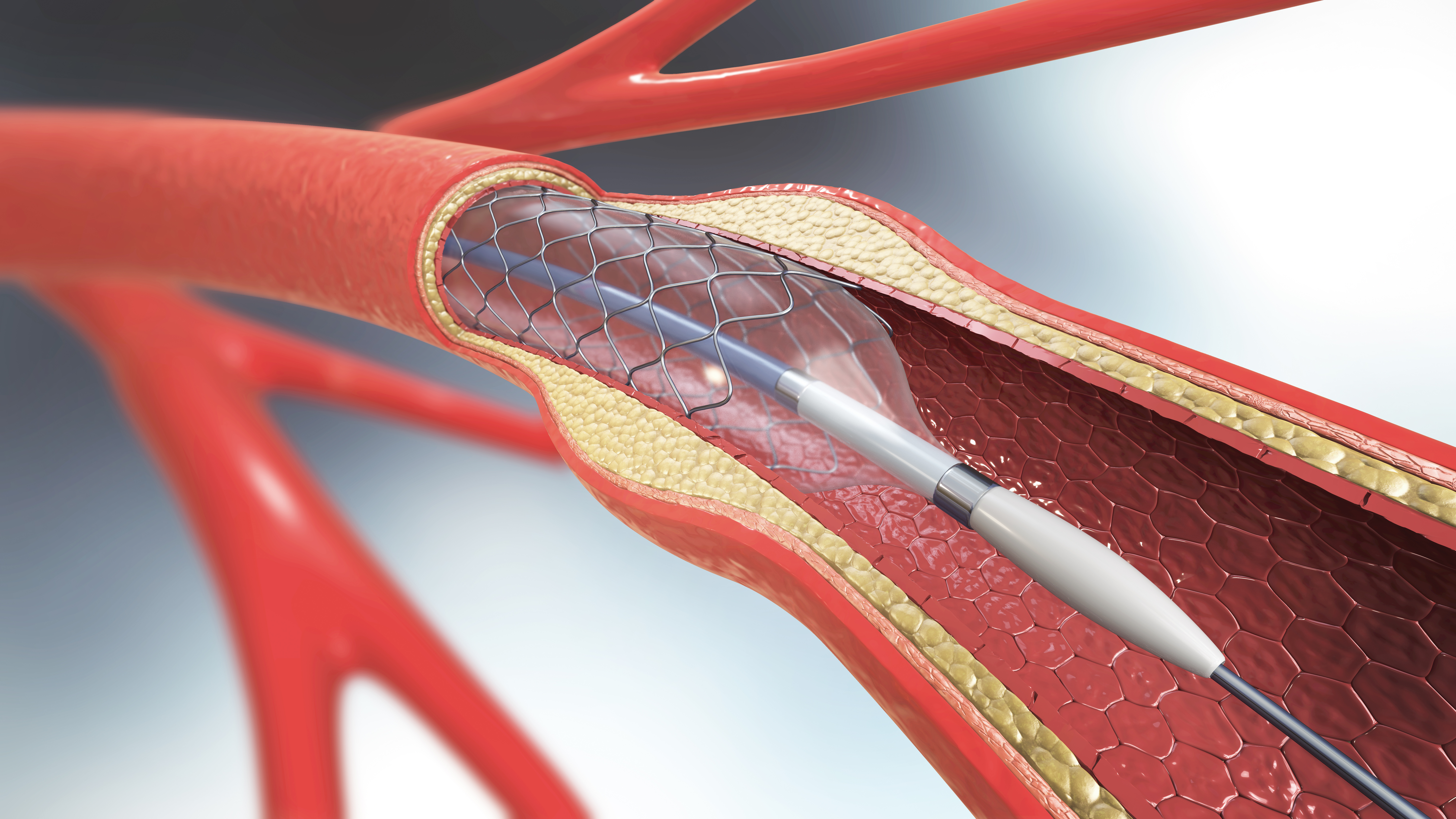 Interventional Cardiology | UNC Health