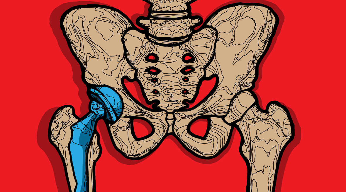 Joint Replacement Surgery & Arthroplasty | UNC Health